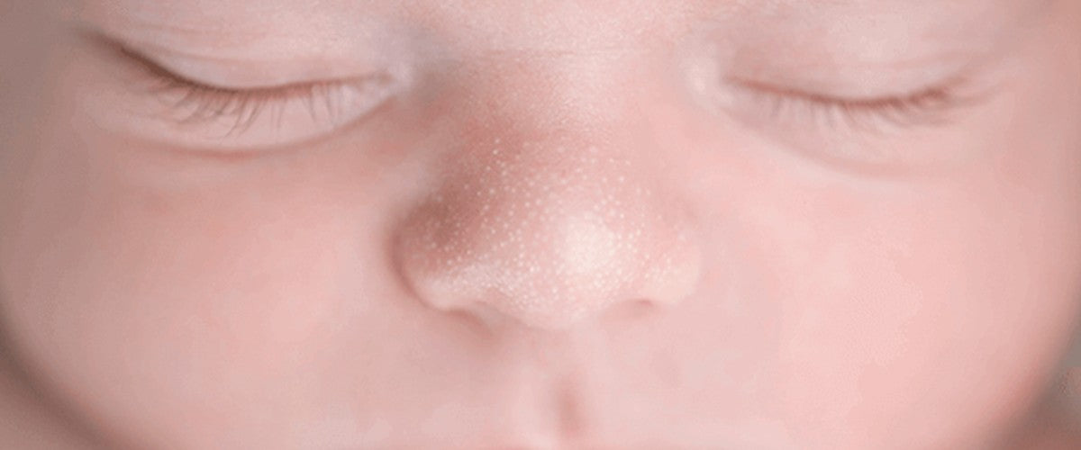 What is Baby Milia? – Better Health Today Malta